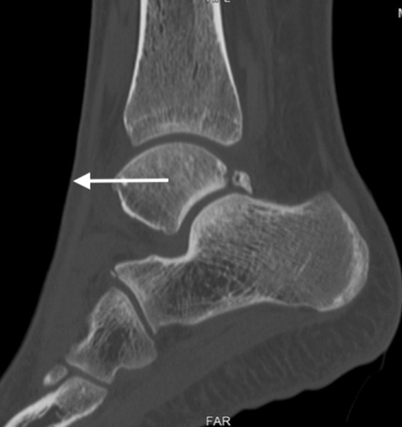 Chronic lateral ankle instability increases the likelihood for surgery ...
