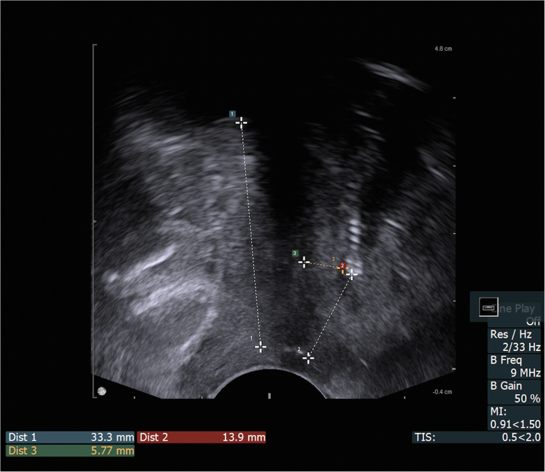 Introital ultrasound in the diagnosis of lower urinary tract symptoms ...