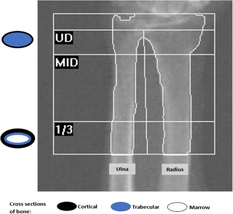 Abaloparatide effect on forearm bone mineral density and wrist fracture ...