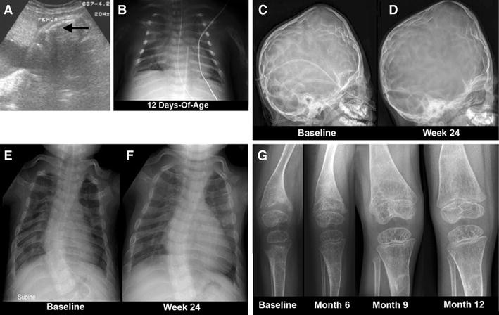 Alkaline Phosphatase and Hypophosphatasia | SpringerLink
