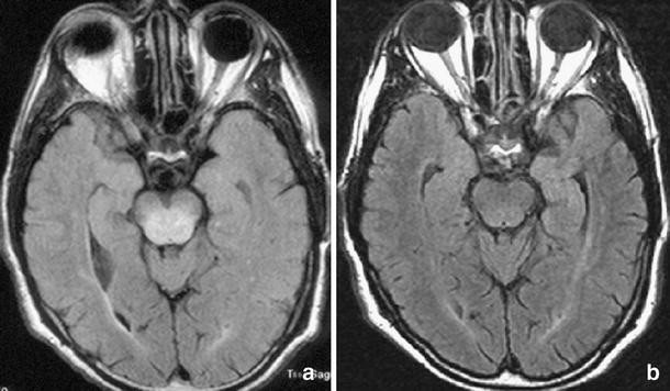 Idiopathic inflammatory-demyelinating diseases of the central nervous system | SpringerLink