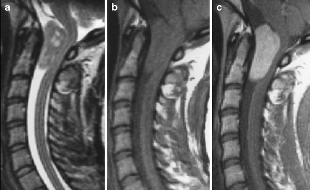 Intradural spinal tumors: current classification and MRI features ...