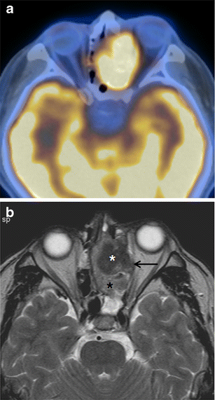 18F-FDG PET/CT findings of sinonasal inverted papilloma with or without ...