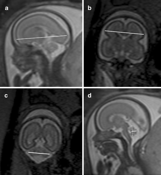 Measurements of the normal fetal brain at gestation weeks 17 to 23: a ...