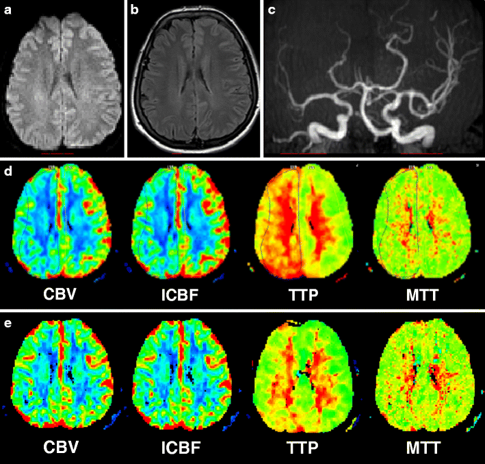Perfusion-weighted MR imaging in persistent hemiplegic migraine ...