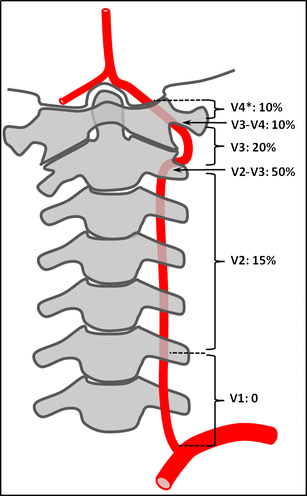Extracranial vertebral artery dissection in children: natural history ...