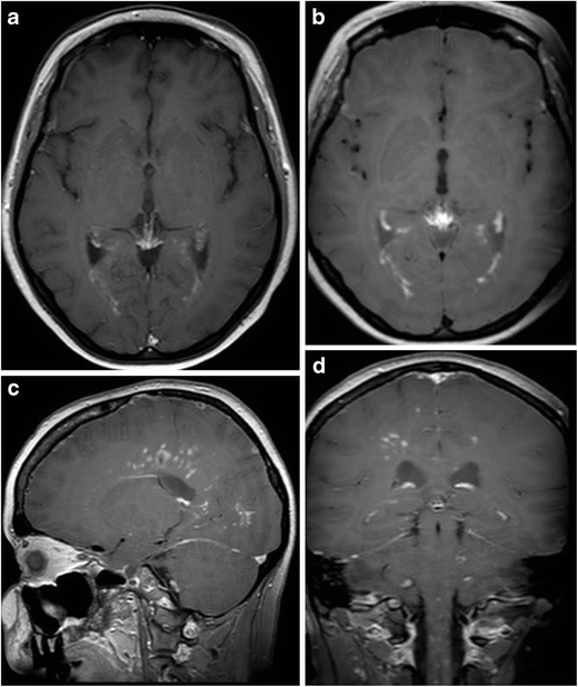 DRESS syndrome: cerebral vasculitic-like presentation | SpringerLink