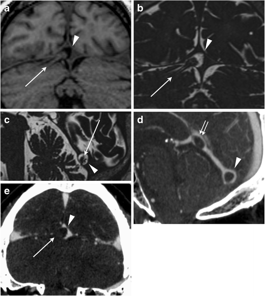 Brain herniations into arachnoid granulations: about 68 cases in 38 ...