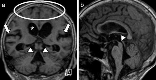Beyond the midbrain atrophy: wide spectrum of structural MRI finding in ...