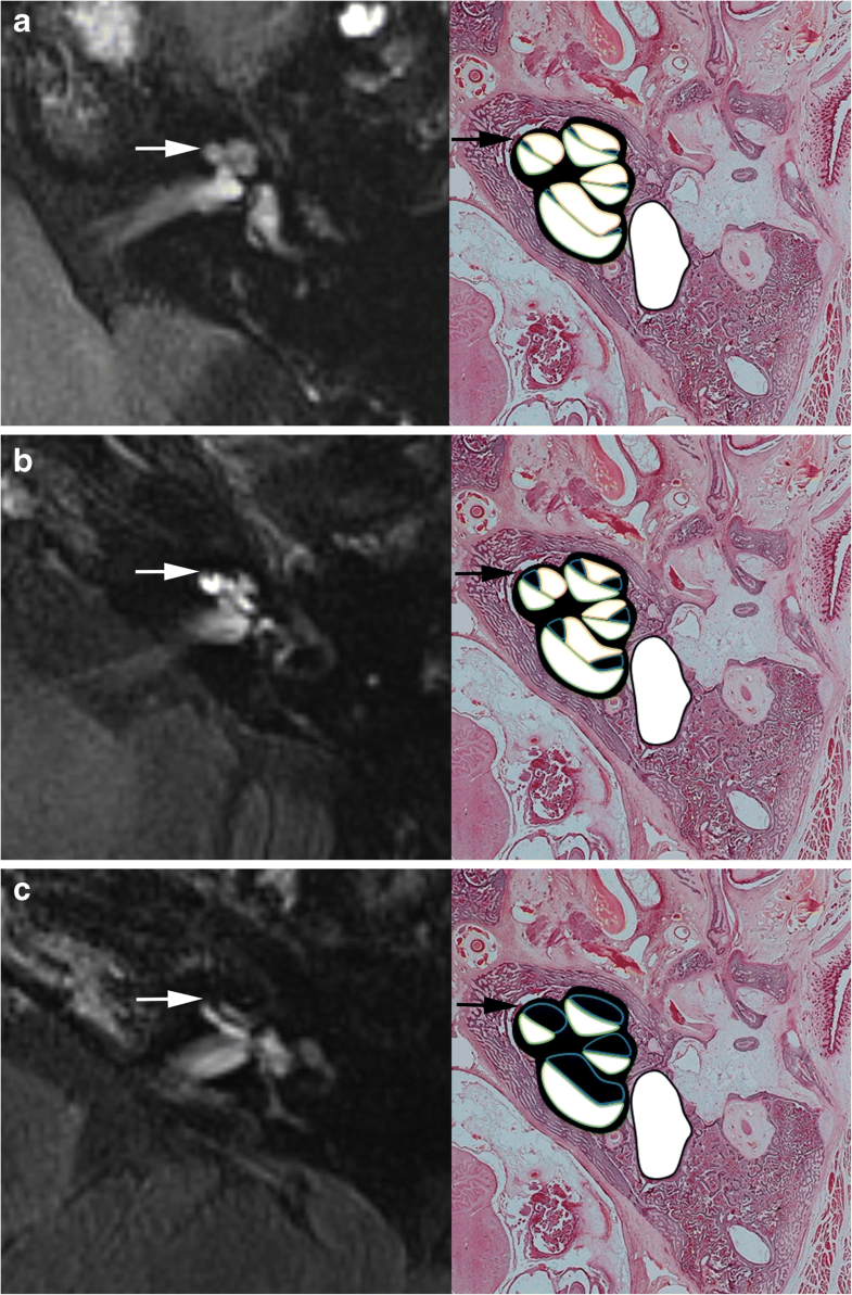The value of four stage vestibular hydrops grading and asymmetric ...