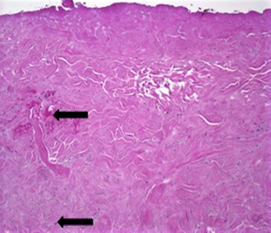 DermACELL: a novel and biocompatible acellular dermal matrix in tissue ...