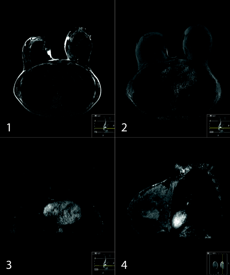 Rapidly-growing pseudoangiomatous stroma hyperplasia (PASH) causing ...