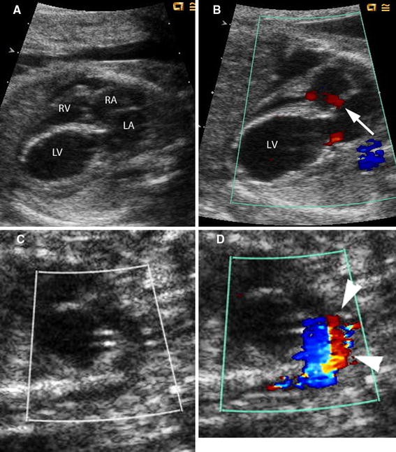 Ross-Konno and Endocardial Fibroelastosis Resection After Hybrid Stage ...