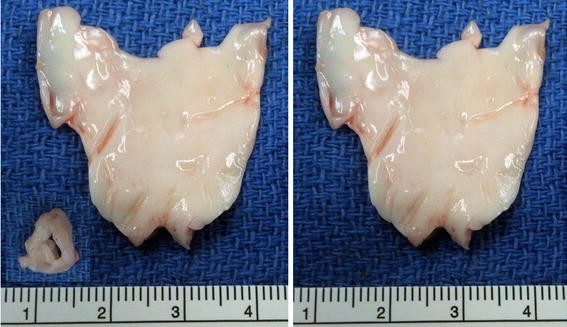 Ross-Konno and Endocardial Fibroelastosis Resection After Hybrid Stage ...