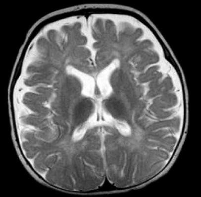 Krabbe disease: unusual MRI findings | SpringerLink