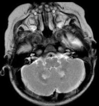 Krabbe disease: unusual MRI findings | SpringerLink