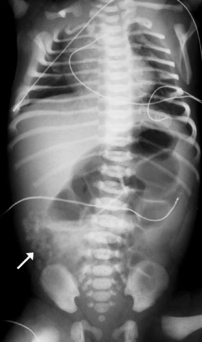 Neonatal intestinal obstruction simulating meconium ileus in infants ...