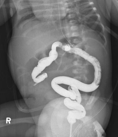 Neonatal intestinal obstruction simulating meconium ileus in infants ...