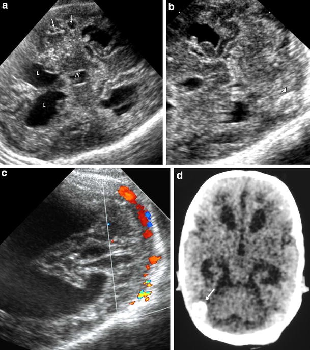 Mastoid fontanelle approach for sonographic imaging of the neonatal ...