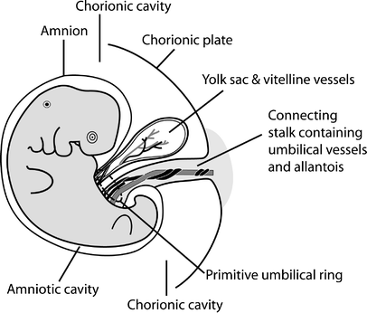 Allantoic cyst: a prenatal clue to patent urachus | SpringerLink