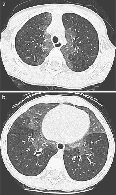 Neuroendocrine cell hyperplasia of infancy (NEHI) | SpringerLink