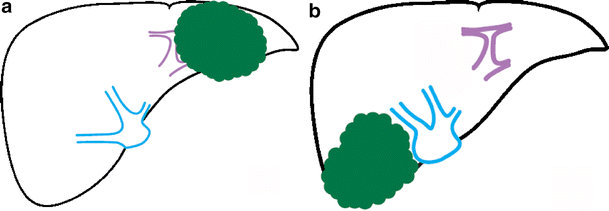 2005 PRETEXT: a revised staging system for primary malignant liver ...