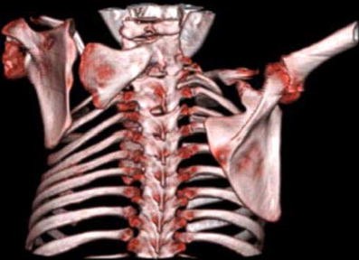 CT demonstration of omovertebral bone | SpringerLink