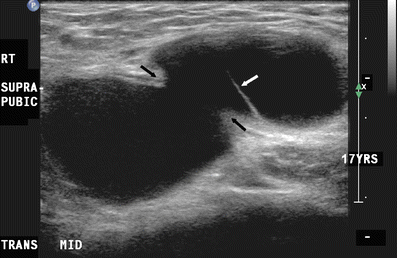 Sonographic appearance of canal of Nuck hydrocele | SpringerLink