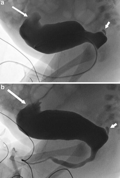 Congenital anomalies of the male urethra | SpringerLink
