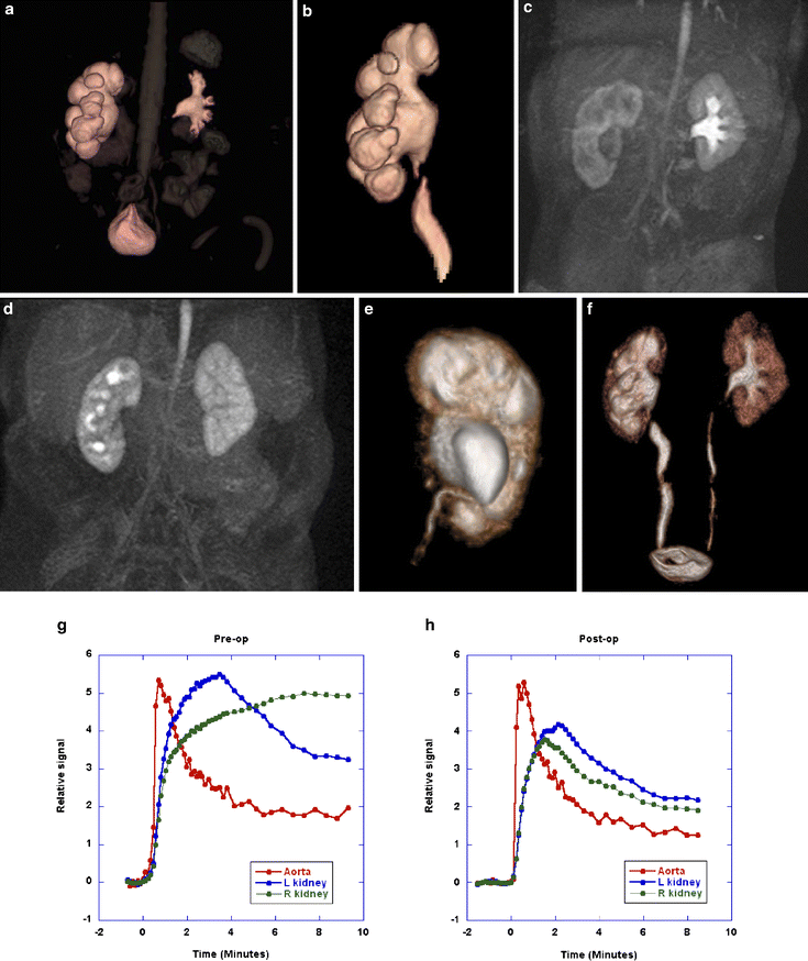 Evaluation of UPJ obstruction before and after pyeloplasty using MR ...