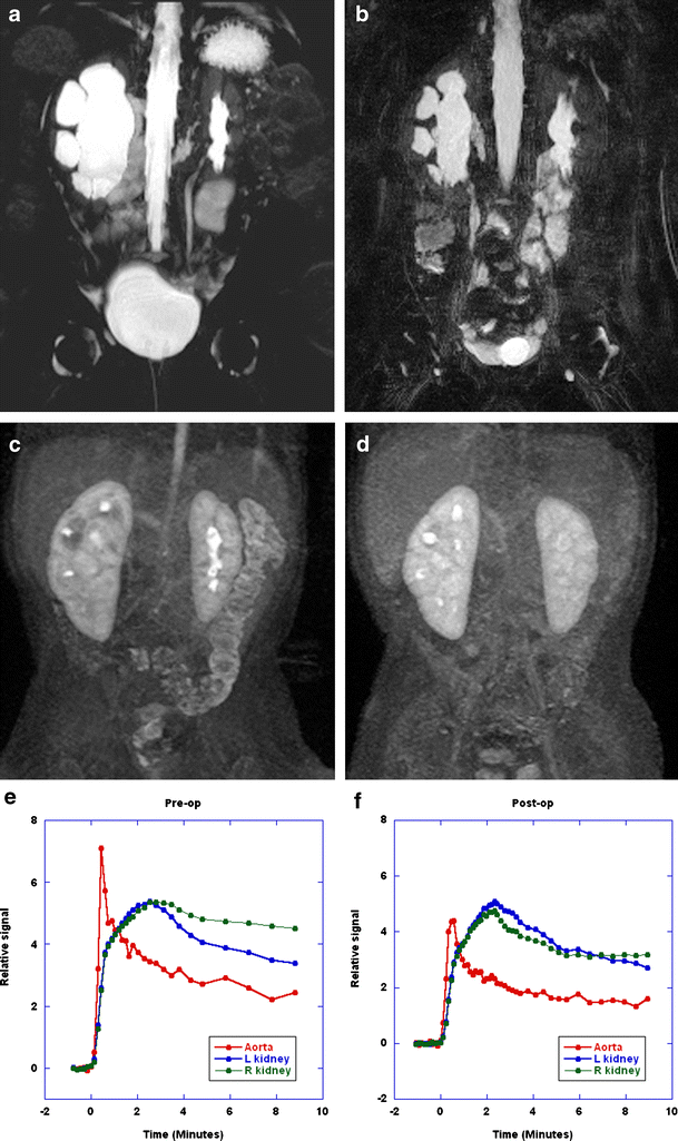 Evaluation of UPJ obstruction before and after pyeloplasty using MR ...