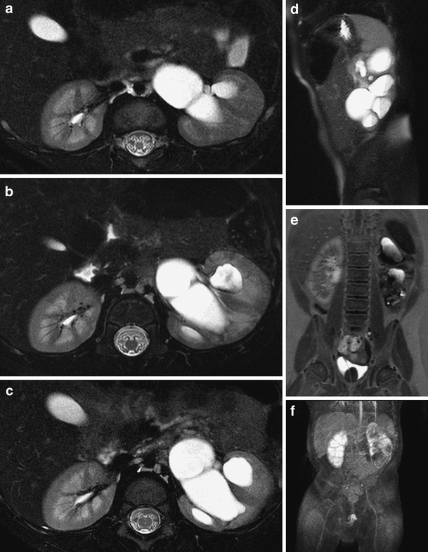Evaluation of UPJ obstruction before and after pyeloplasty using MR ...