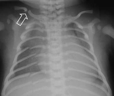 Birth-related mid-posterior rib fractures in neonates: a report of ...