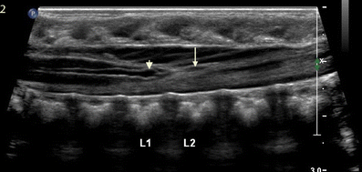 Congenital persistent terminal ventricle and filar cyst | SpringerLink