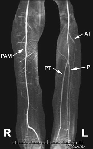 Peronea arteria magna | SpringerLink