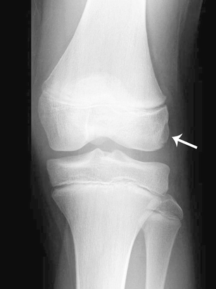 Isolated popliteal tendon avulsion | SpringerLink