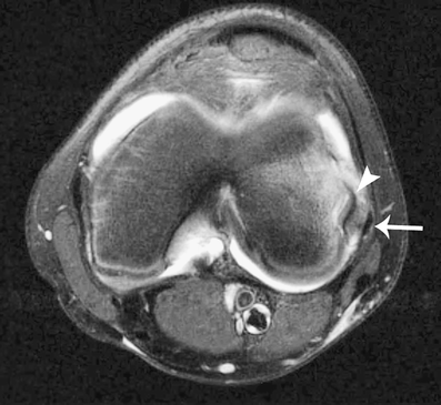 Isolated popliteal tendon avulsion | SpringerLink