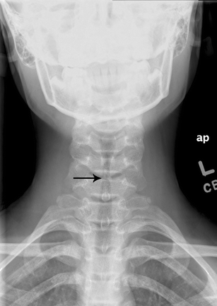 Membranous croup (exudative tracheitis or membranous ...