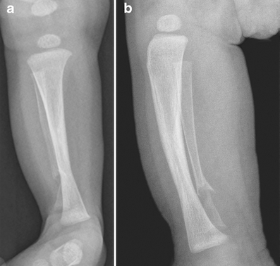 Isolated congenital pseudarthrosis of the fibula | SpringerLink