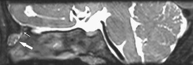 Nasal epidermoid cyst with sinus tract | SpringerLink