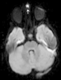 Nasal epidermoid cyst with sinus tract | SpringerLink