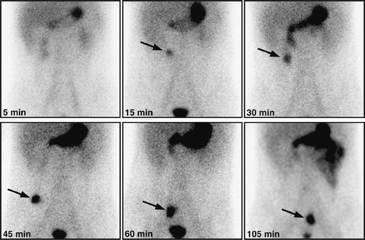 The ‘wandering’ Meckel diverticulum: an unusual scintigraphic finding ...