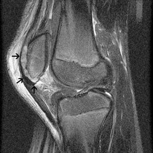 Patellar sleeve fracture | SpringerLink