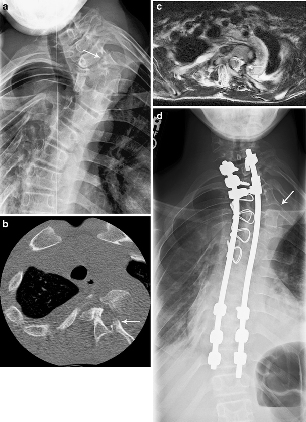 Rib head protrusion into the central canal in type 1 neurofibromatosis ...