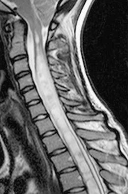 Syringosubarachnoid shunt for syringomyelia associated with Chiari I ...