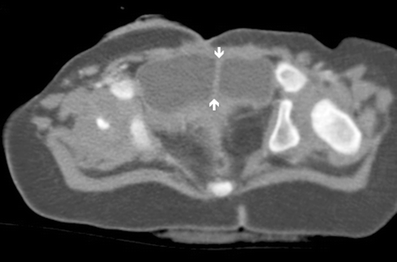 Duplicated bladder | SpringerLink
