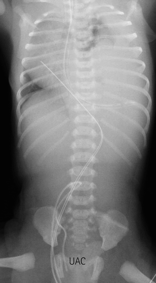 Umbilical vein catheterization—appropriate and inappropriate placement ...