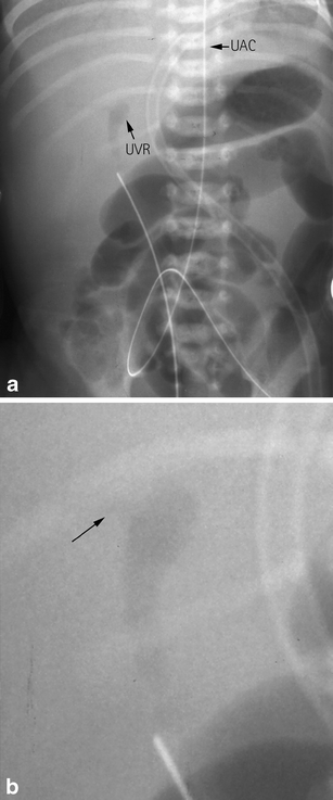 Umbilical vein catheterization—appropriate and inappropriate placement ...