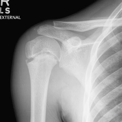 Little League shoulder: a growth plate injury | SpringerLink