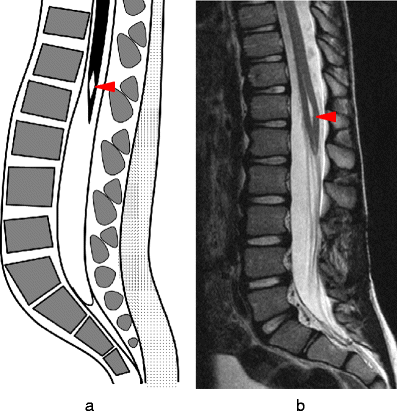 MRI of closed spinal dysraphisms | SpringerLink